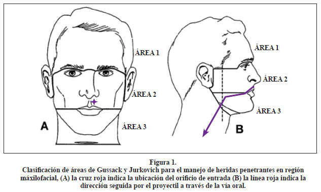 Herida en cavidad oral por proyectil de arma de fuego con trayecto de ... Herida en cavidad oral por proyectil de arma de fuego con trayecto de ...