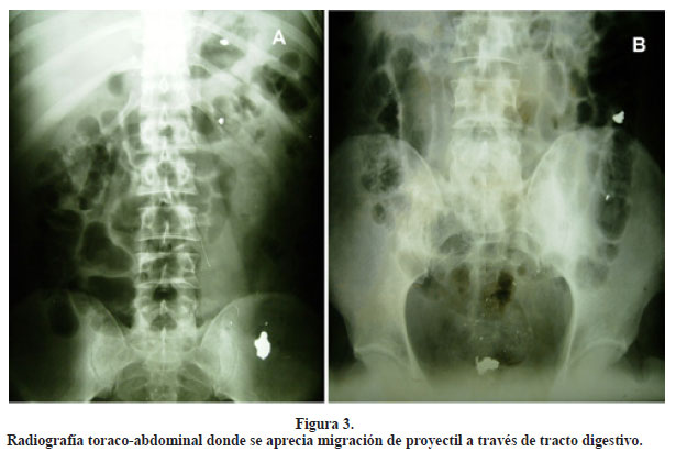 Herida en cavidad oral por proyectil de arma de fuego con trayecto de ... Herida en cavidad oral por proyectil de arma de fuego con trayecto de ...