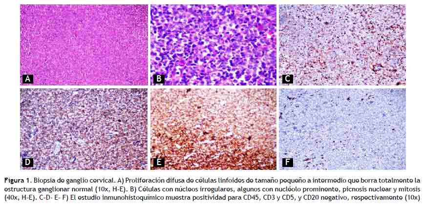 Leucemia/Linfoma de células T del adulto y criptococosis sistémica ... Leucemia/Linfoma de células T del adulto y criptococosis sistémica ...