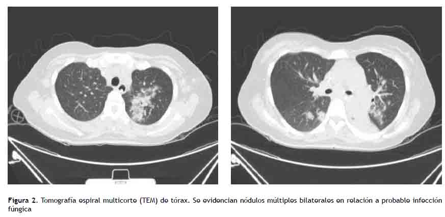 Leucemia/Linfoma de células T del adulto y criptococosis sistémica ... Leucemia/Linfoma de células T del adulto y criptococosis sistémica ...