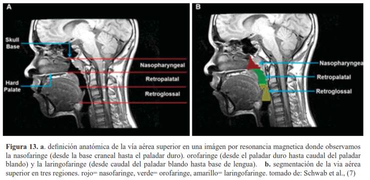 Anatomía De La Nasofaringe Anatomía Nasofaríngea En TC