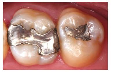 Restauración clase II MOD mediante uso de resina bulk-fill fluida y resina de estratificación ...