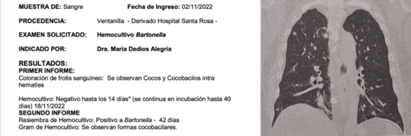 Sarcoma de Kaposi y Coinfeccion por Bartonella en paciente VIH positivo