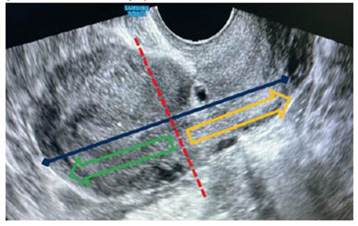 Gestación ectópica sobre cicatriz de cesárea