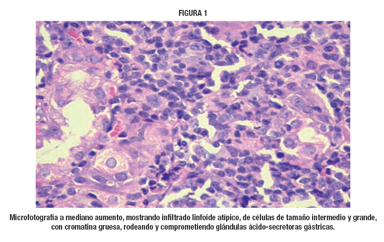 Leucemia-Linfoma de Células T del Adulto; Leucemia-Linfoma Aguda de ... Leucemia-Linfoma de Células T del Adulto; Leucemia-Linfoma Aguda de ...